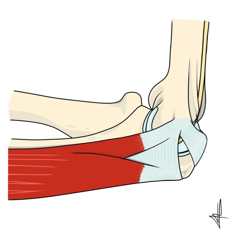 Compression du nerf ulnaire au coude - Orthosport