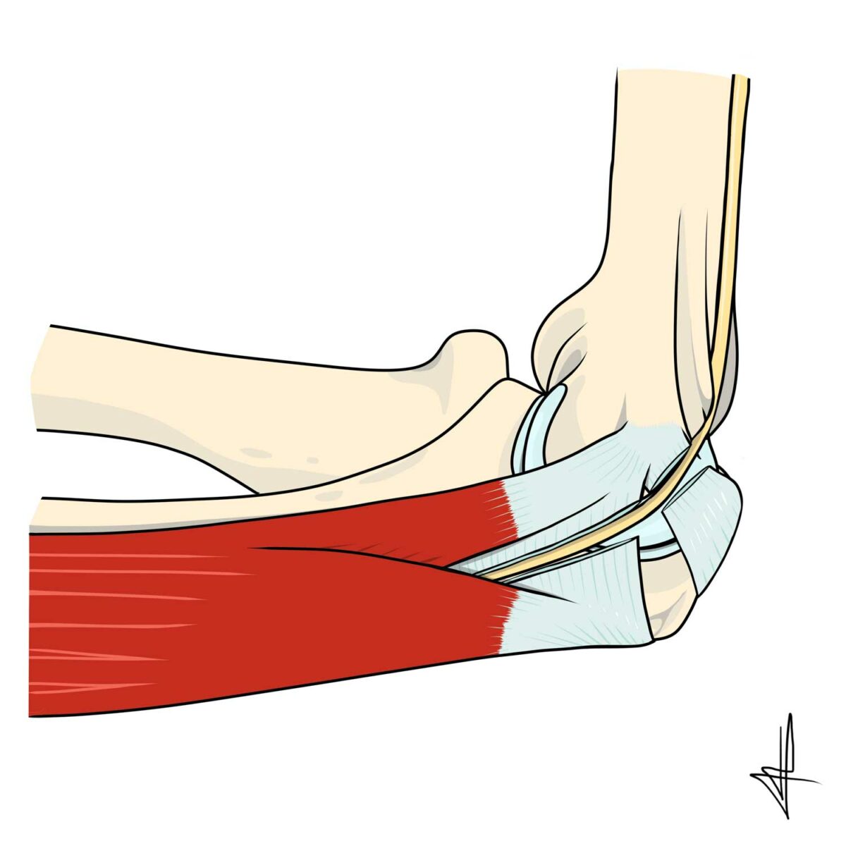 Compression du nerf ulnaire au coude - Orthosport